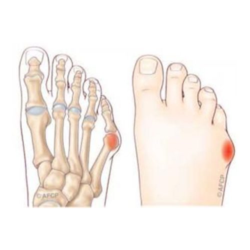 Chaussures pour quintus varus - Tamalou Orthopédie